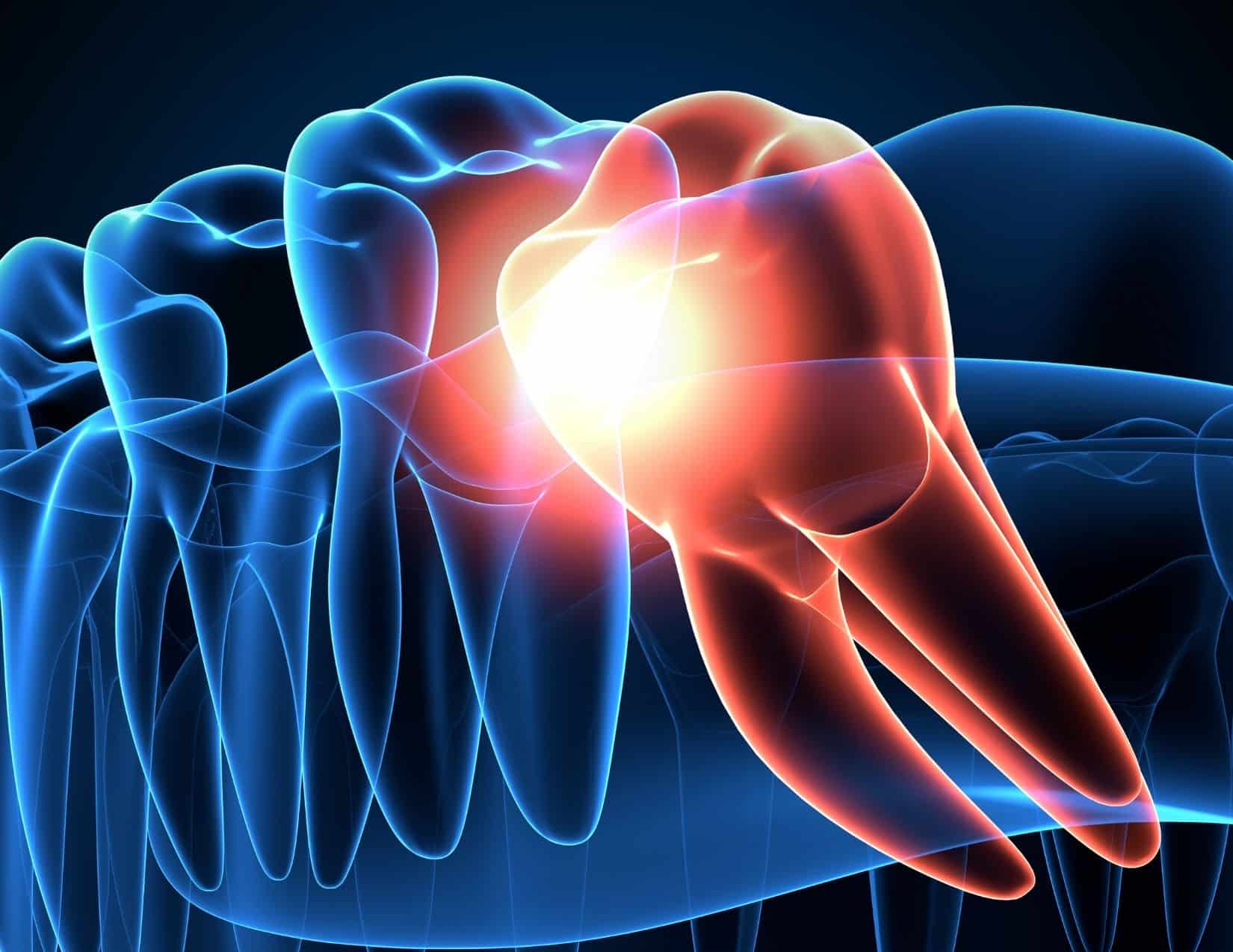Surgery of Wisdom Teeth at Mario Garita Dental Clinic